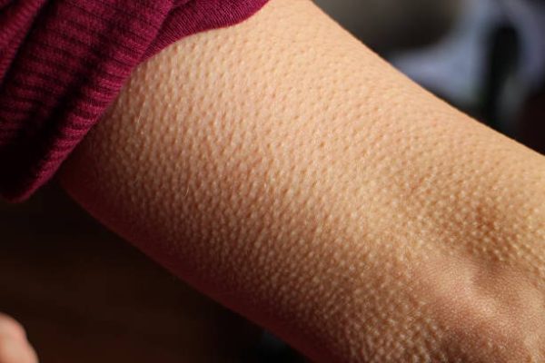 Why Do We Get Goosebumps When We’re Cold or Scared? - Tremhost News